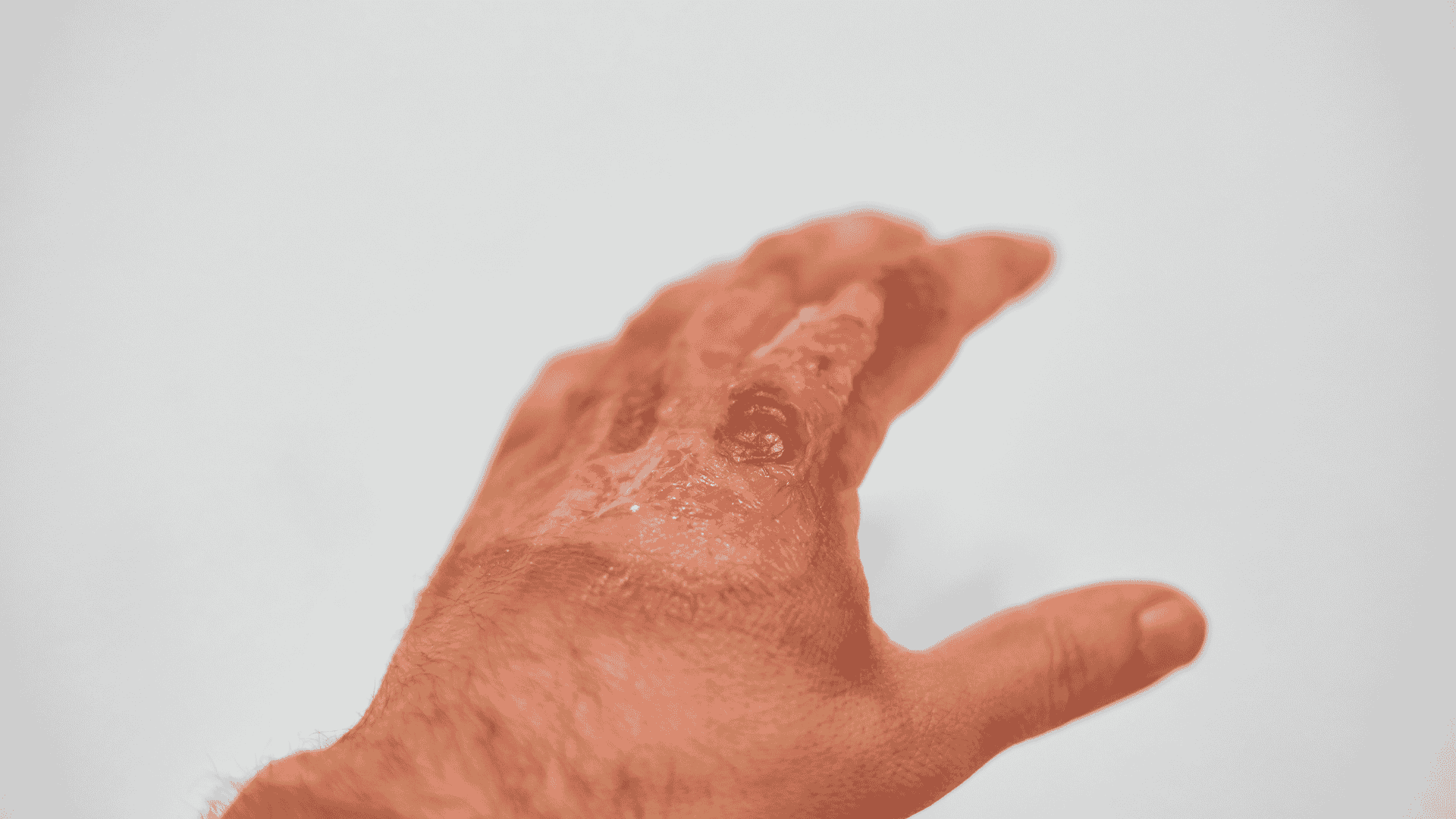 Burns & Scar Management in Lahore | Skin Restoration Experts